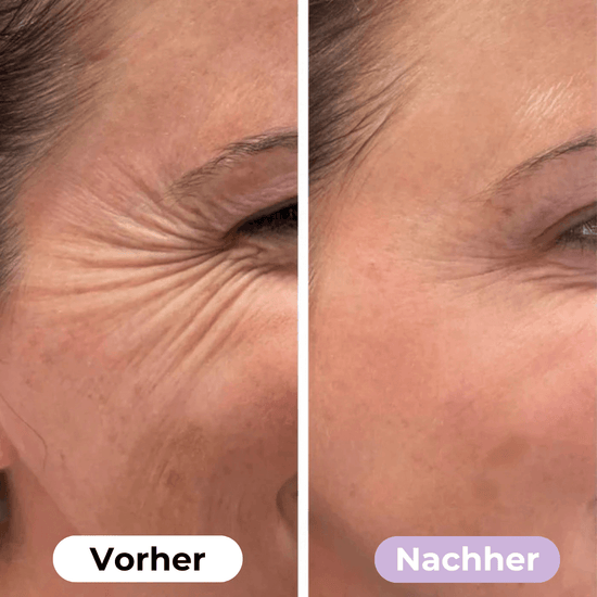 ScarRelief ™ | Silikon-Narbenpflaster – Nalora