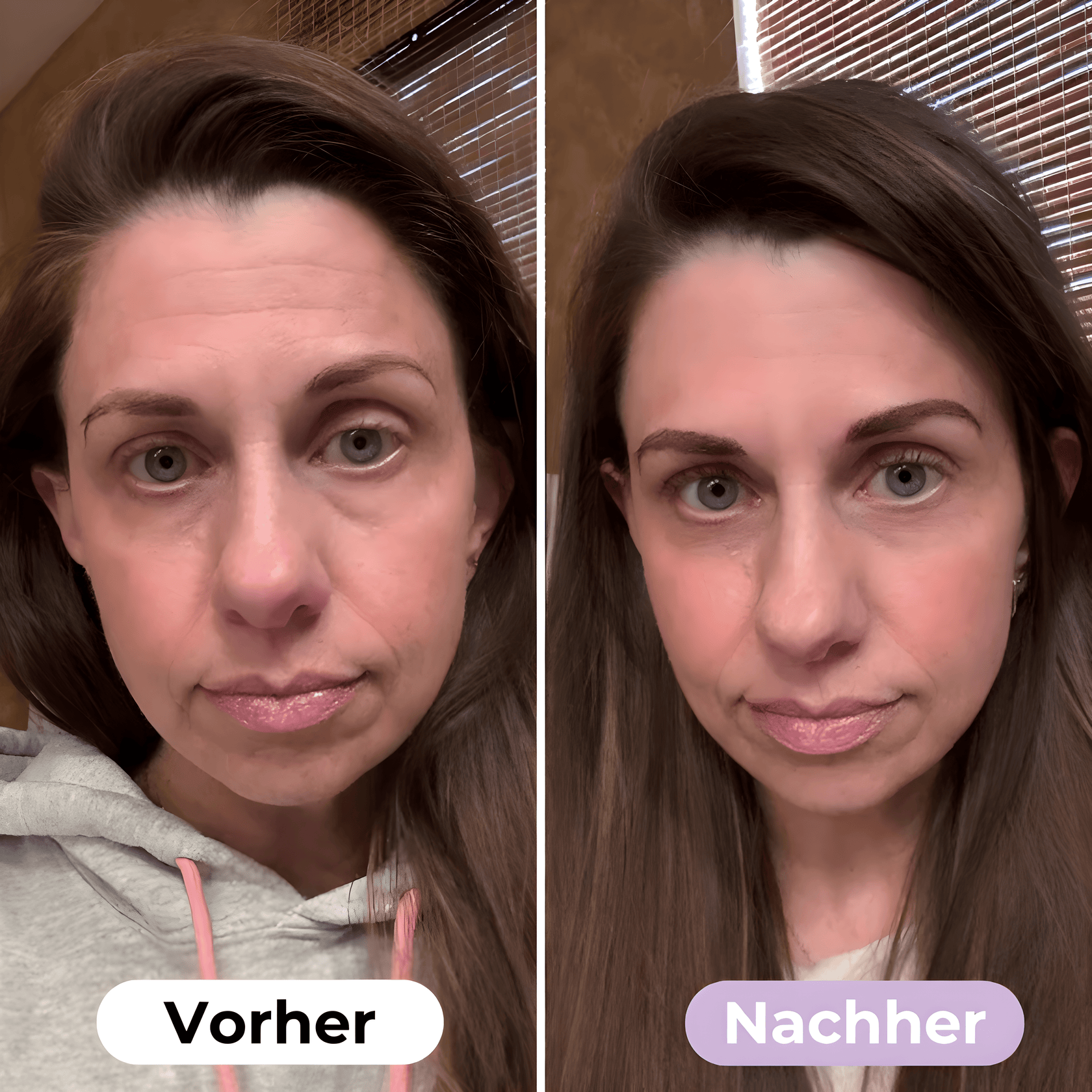 ScarRelief ™ | Silikon-Narbenpflaster – Nalora